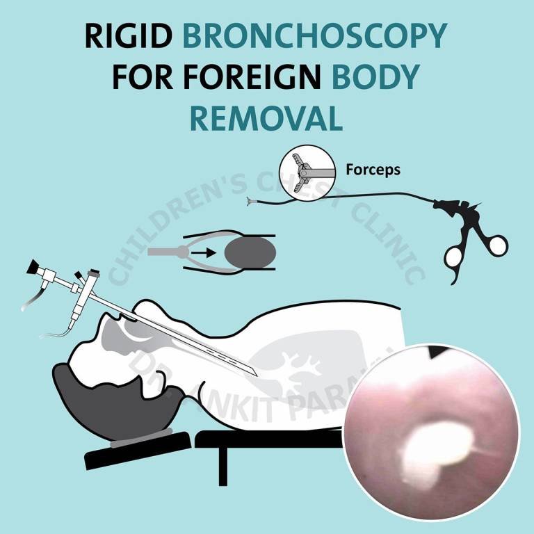 Rigid Bronchoscopy for Children – Dr. Ankit Parakh – India's best ...