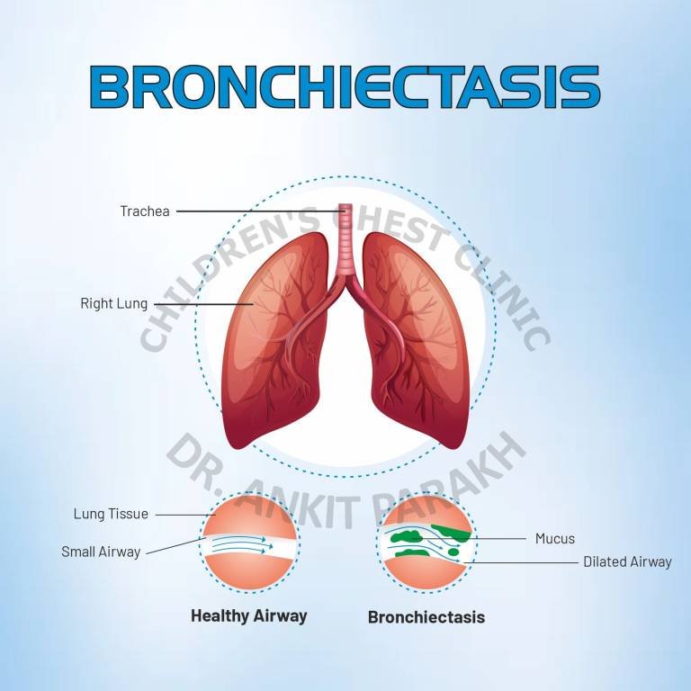 Bronchiectasis: Causes, Symptoms, and Diagnosis - Dr. Ankit Parakh ...