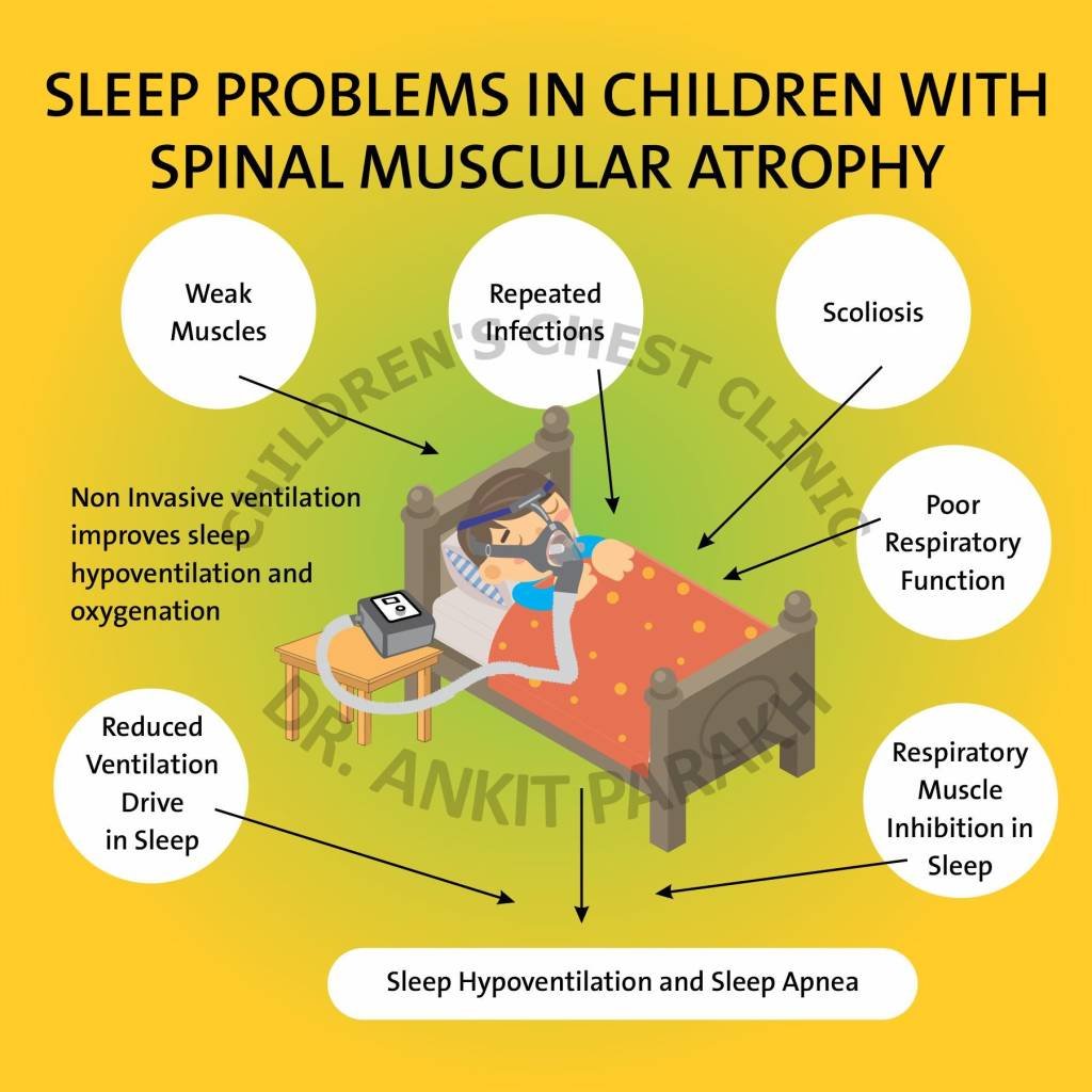 Sleep Problems in children with Spinal muscular atrophy (SMA)? – Dr ...