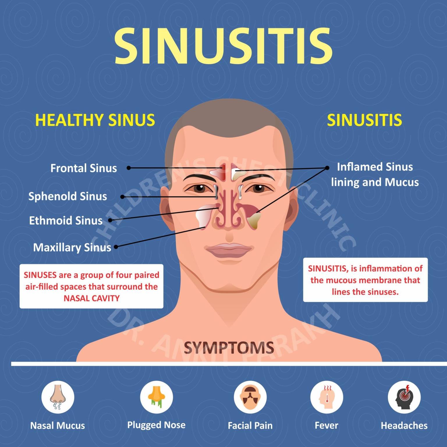Sinusitis in Children – Dr. Ankit Parakh – India's best Pediatric ...