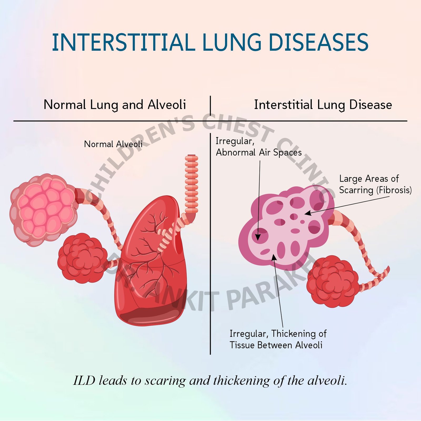Diseased Lungs