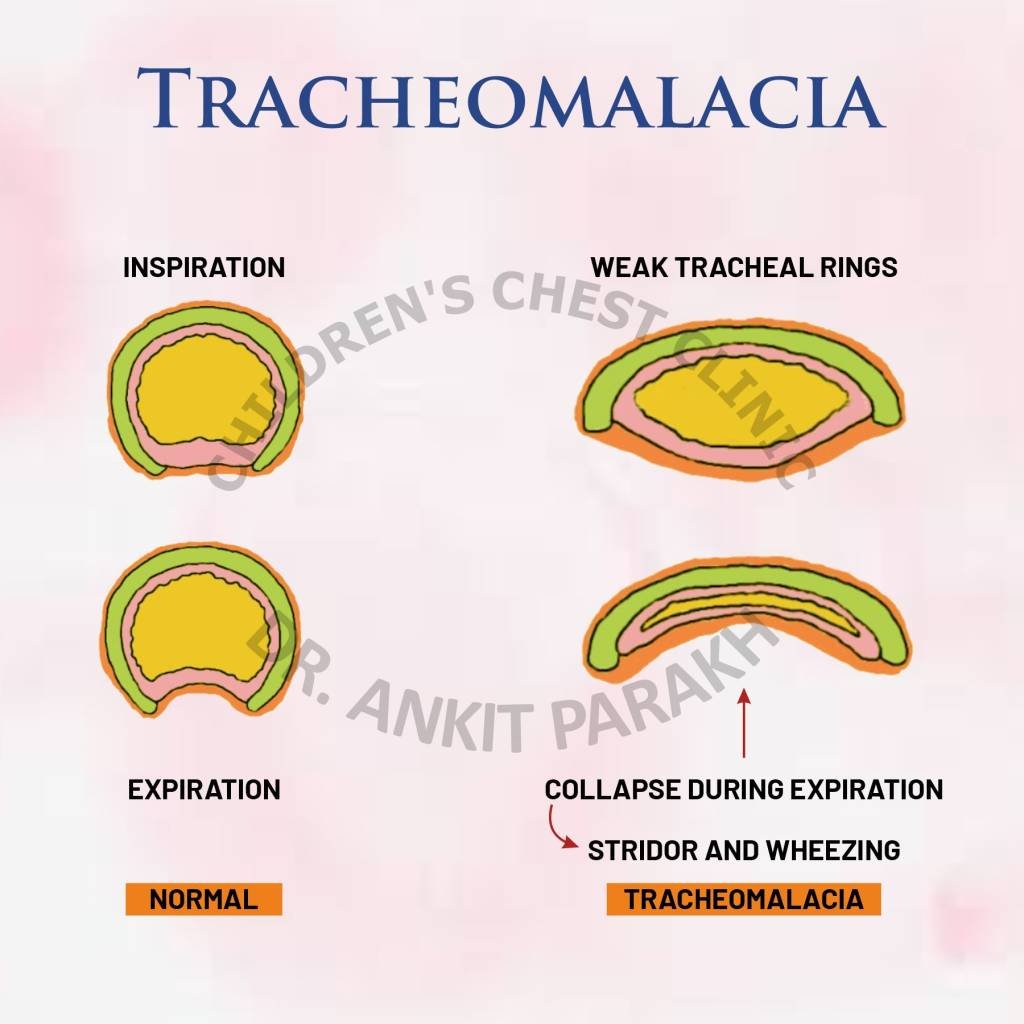 Tracheomalacia: An important cause of wheezing in young infants! – Dr ...