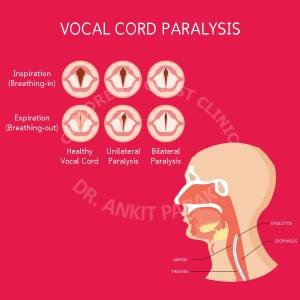 Vocal Cord Palsy in Neonates and babies: Causes, Diagnosis and ...
