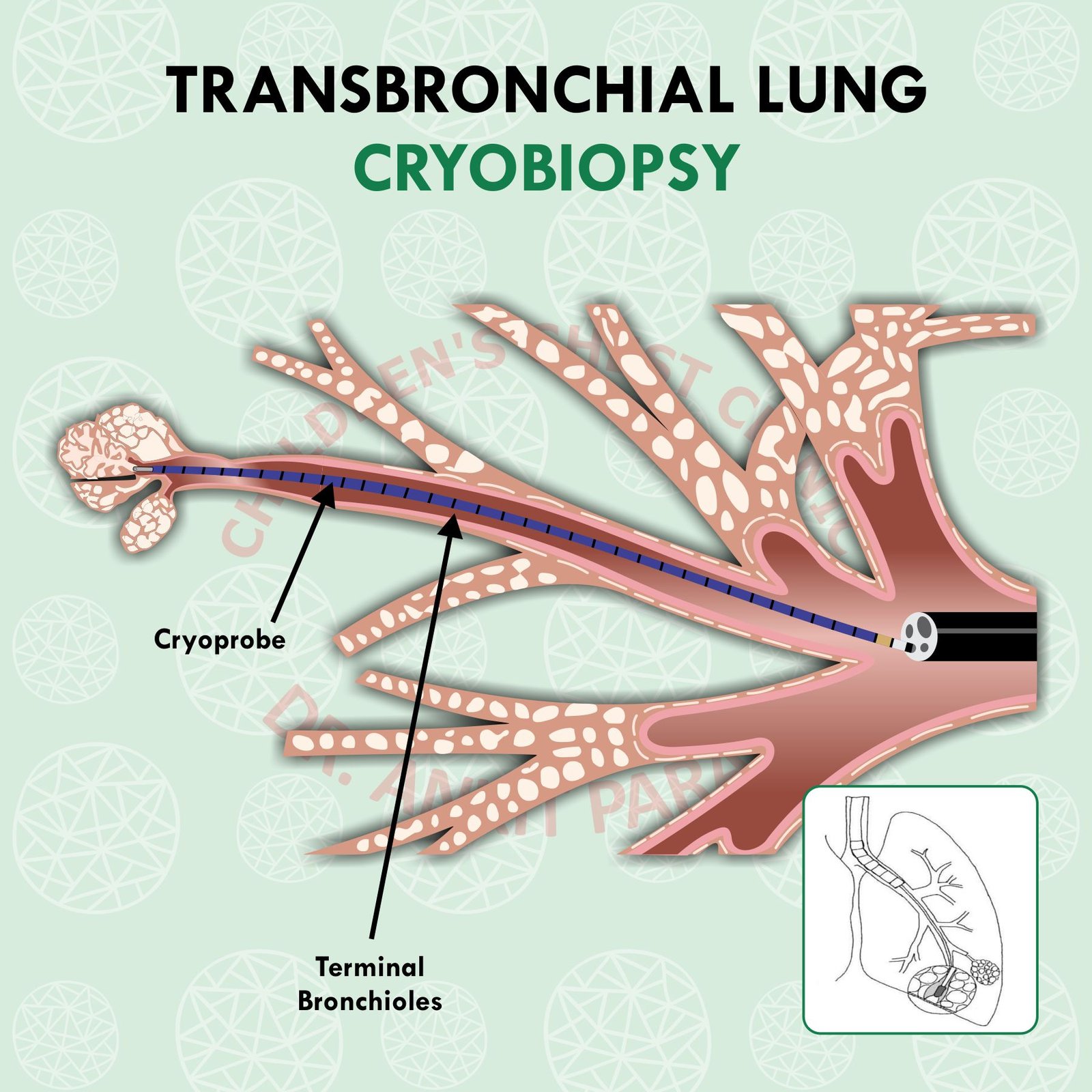 Lung Biopsy in Children: An important tool for diagnosis of complex ...
